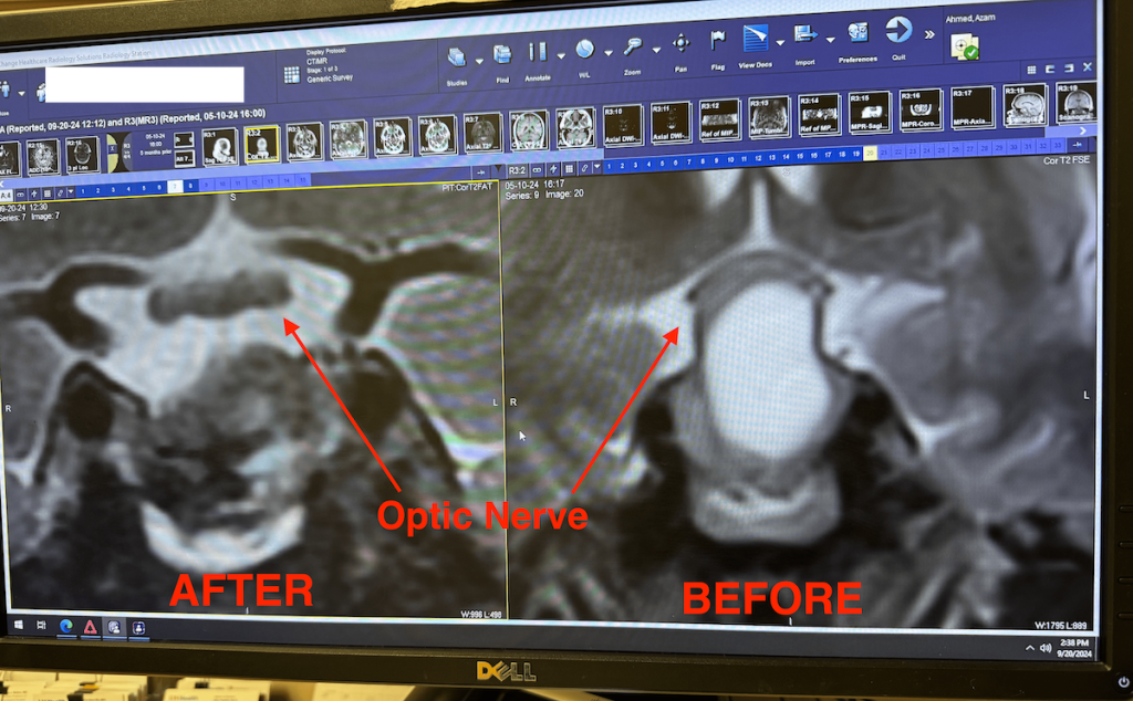 My Pituitary Adenoma (Tumor) Story